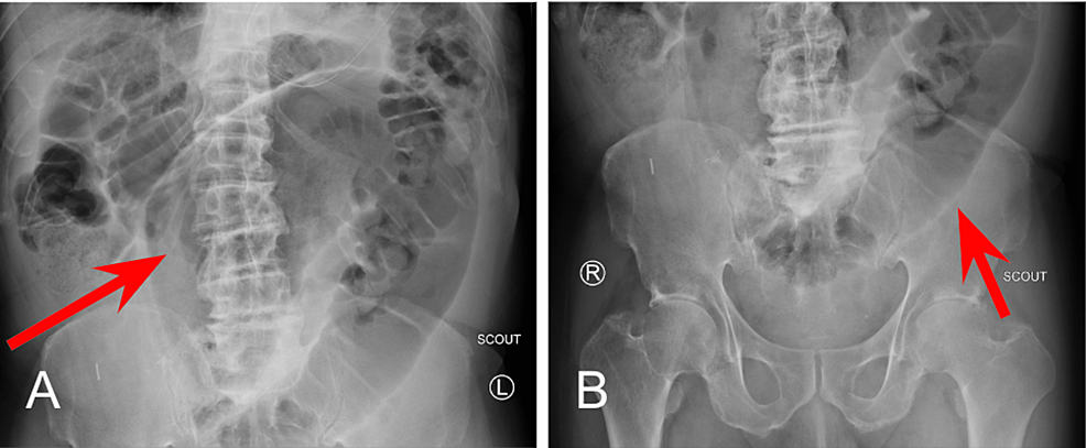 Simultaneous Sigmoid Volvulus and Small Bowel Obstruction: A Case ...